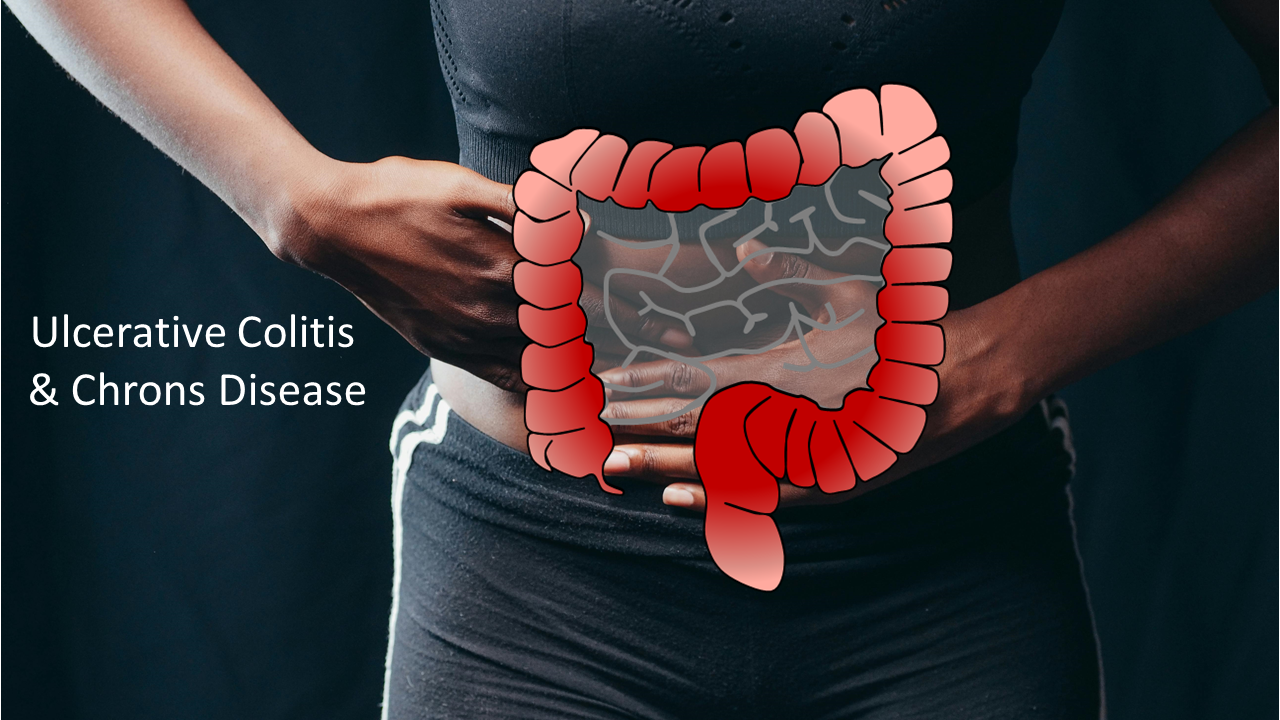 Inflammatory Bowel Disease (Ulcerative Colitis and Chrons Disease ...